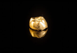 Gold Crowns and Bridges – German Zahn Dental Lab